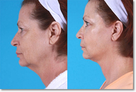 Cosmetic and Laser Surgery | Jacksonville, FL | Precision Dermatology ...